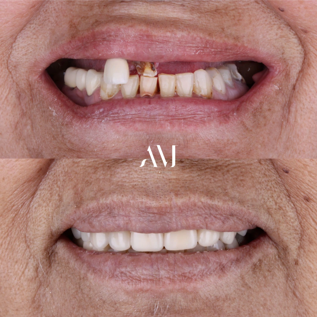 Prótesis Totales - AM Dental Studio GDL - Clínica Odontológica de Alta ...